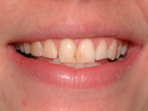 Internal Teeth Bleaching Before and After - Cosmic Smile Dental