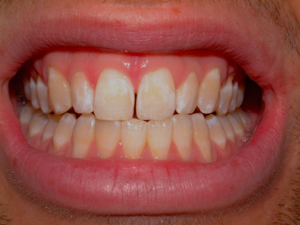 Internal Teeth Bleaching Before and After - Cosmic Smile Dental