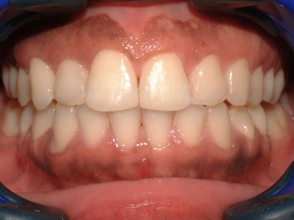 Sydney Invisalign - Before and After - Cosmic Smile Dental
