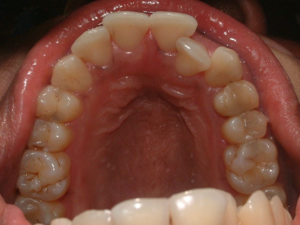 Sydney Invisalign - Before and After - Cosmic Smile Dental