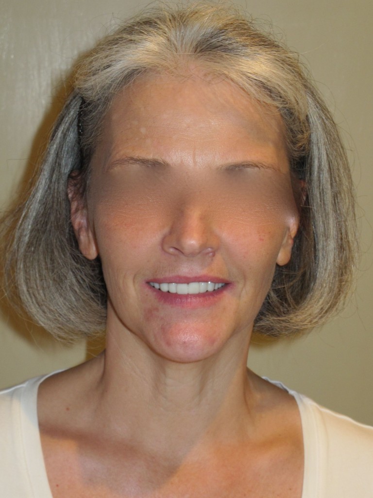 Snap on Smile Before and After - Cosmic Smile Dental