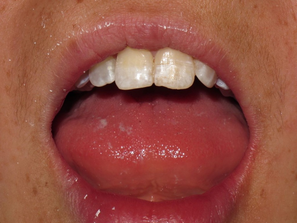 Internal Teeth Bleaching Before and After - Cosmic Smile Dental