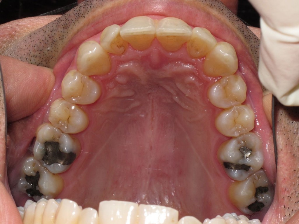 Sydney Invisalign | Before and After | Cosmic Smile Dental