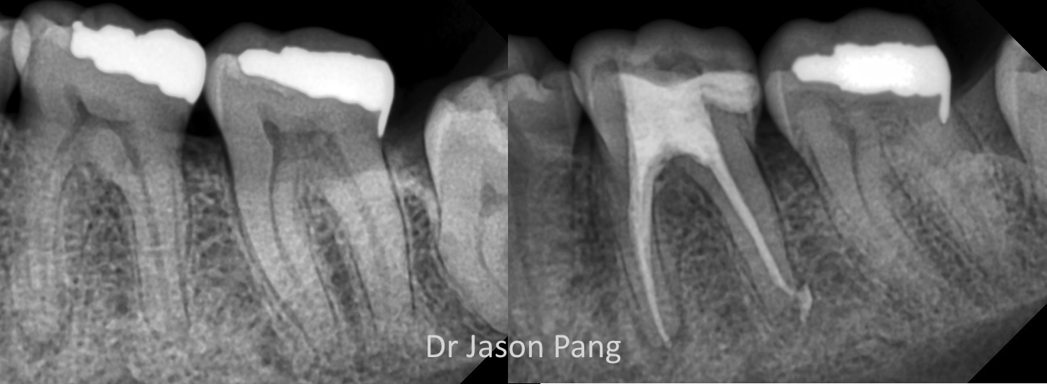 Laser Endodontic Treatment with PIPS | Cosmic Smile Laser Dental
