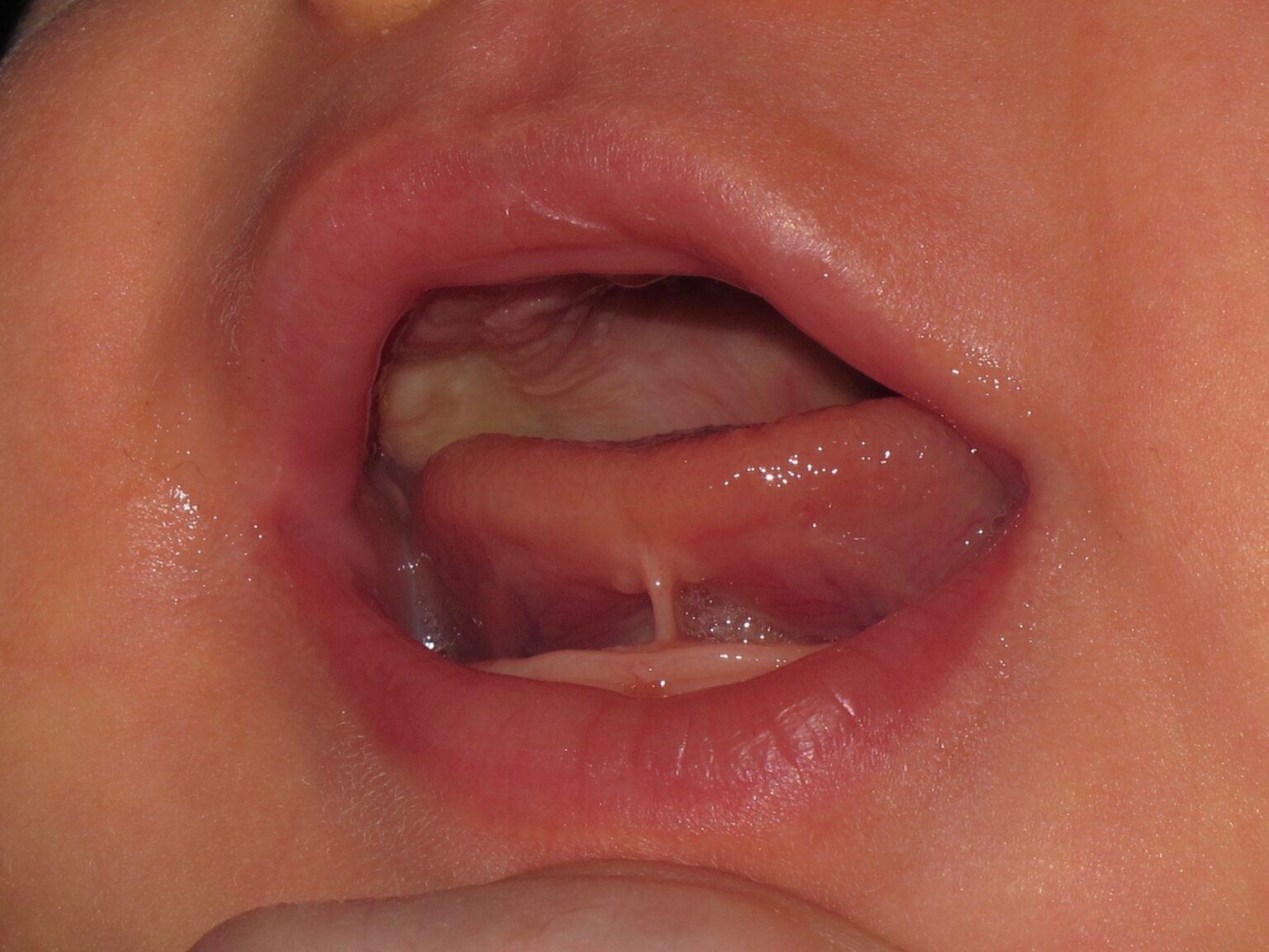 Frenectomy And Tongue Tie Laser Treatment Sydney Cosmic Smile