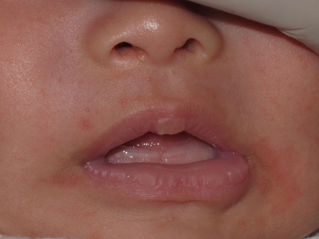Frenectomy And Tongue Tie Laser Treatment Sydney Cosmic Smile